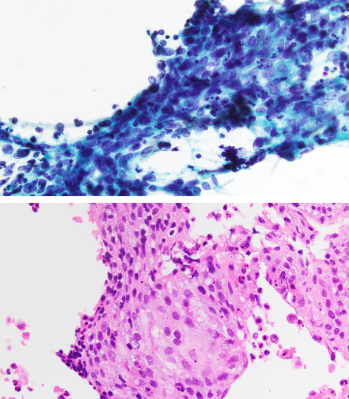 High-Risk HPV Testing in Head and Neck Carcinoma: Key Updates from the ...