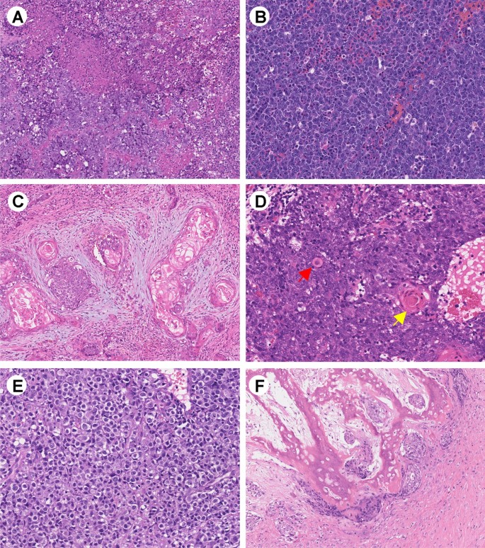 NUT Carcinoma of the Head and Neck: Clinicopathologic and Molecular ...