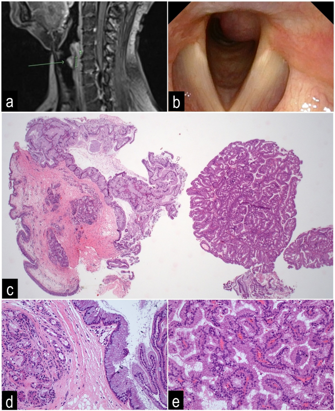 Subglottic Laryngeal Salivary Gland Intraductal Papillary Mucinous ...