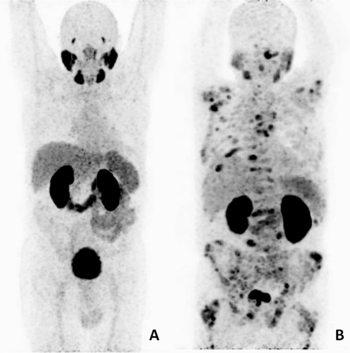 Physiological biodistribution on Ga68-PSMA PET/CT and the factors ...