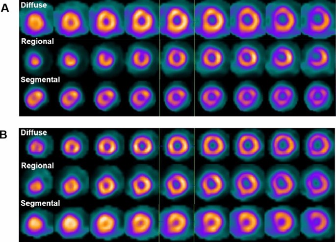 Assessment of myocardial injury by SPECT myocardial perfusion imaging ...