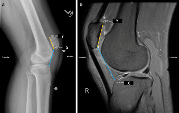 Tibial Tubercle Osteotomy: Indications, Outcomes, and Complications ...