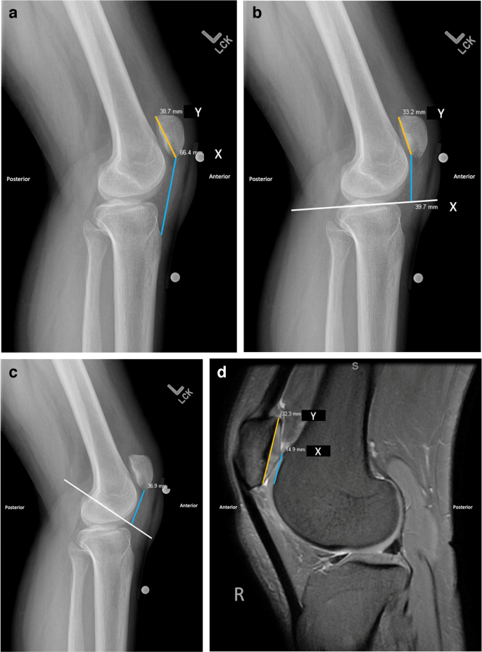 Tibial Tubercle Osteotomy: Indications, Outcomes, and Complications ...
