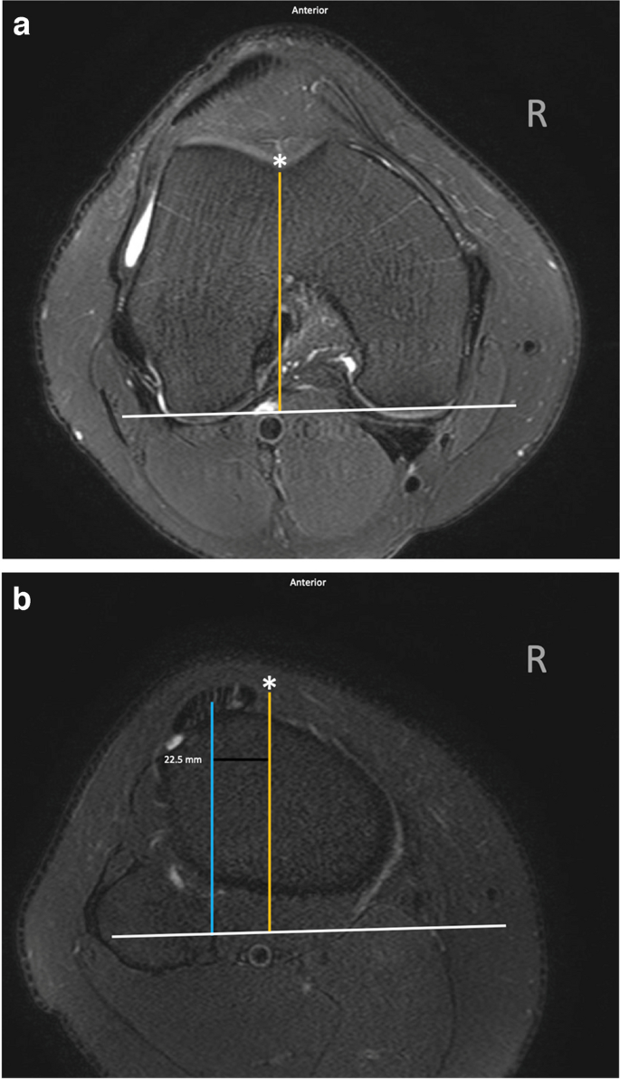 Tibial Tubercle Osteotomy: Indications, Outcomes, and Complications ...