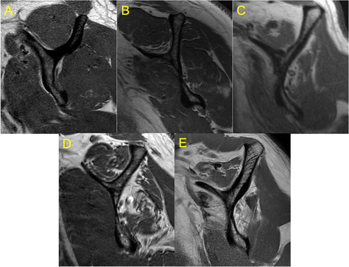 Muscle Health & Fatty Infiltration with Advanced Rotator Cuff Pathology ...