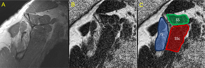 Muscle Health & Fatty Infiltration with Advanced Rotator Cuff Pathology ...