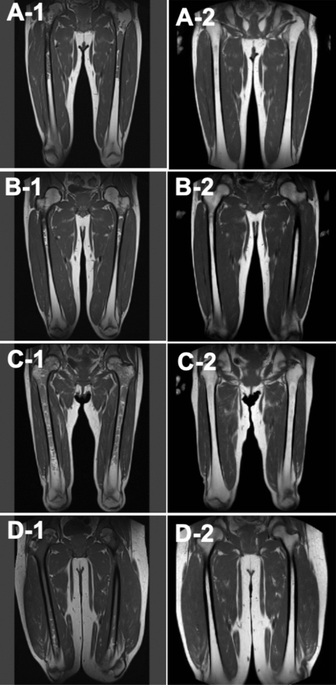 Dynamic changes in femoral bone marrow MRI in patients with chronic ...