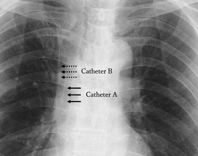 Accurate tacrolimus monitoring by dual peripherally inserted central ...