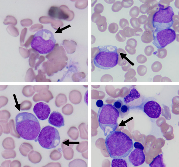 Thrombophagocytosis by myeloid blasts in acute myeloid leukemia with ...