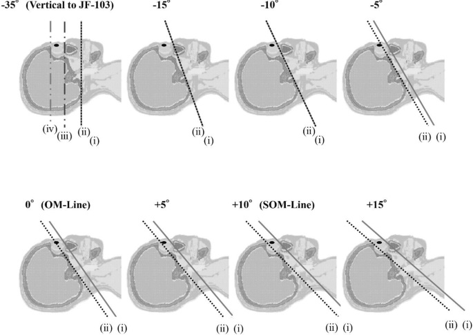 Optimizing lens and organ dose evaluation in head CT examinations using ...