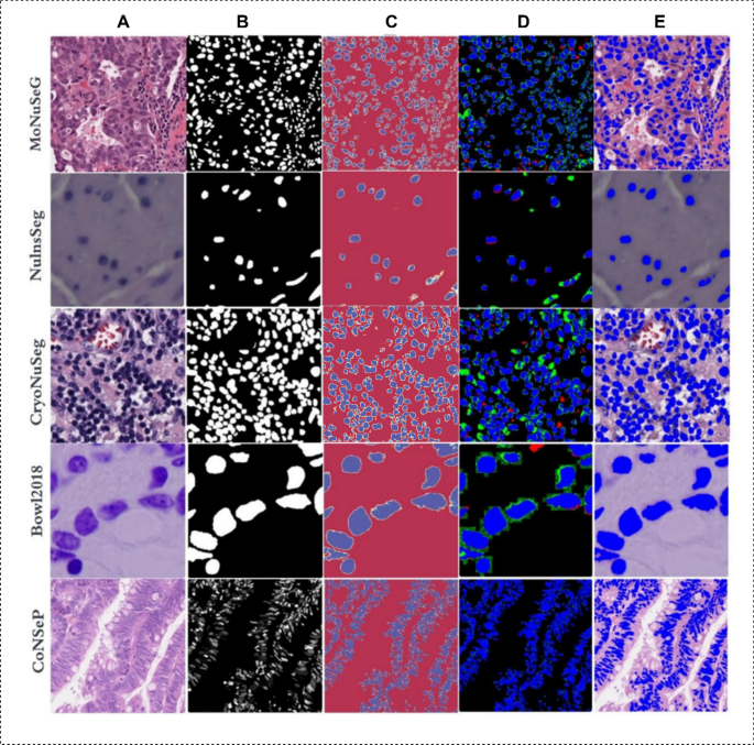 Automatic cancer nuclei segmentation on histological images: comparison ...