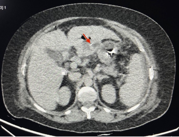 A Fish Bone in the Liver Abscess with Intestinal Obstruction | Indian ...