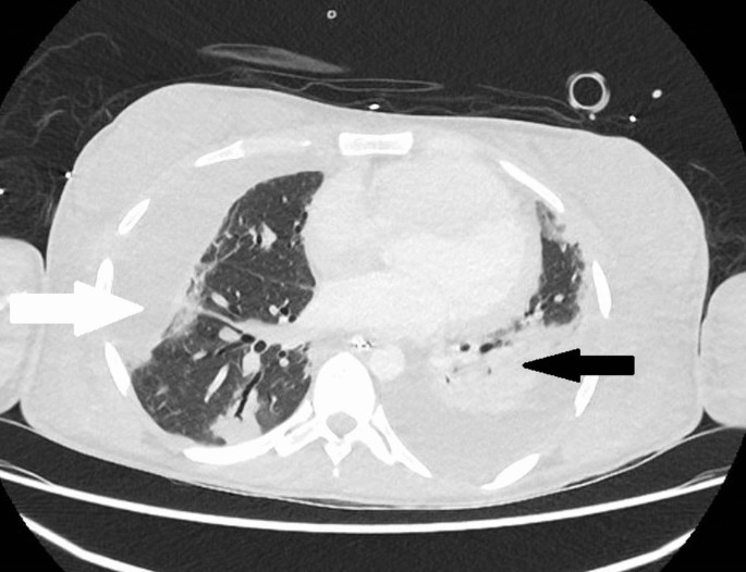 A Complex Case of Lemierre’s Syndrome: Challenges in Diagnosis and ...