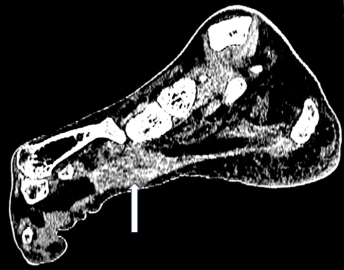 Imaging of Multinodular Plantar Fibromatosis—Ledderhose Disease ...