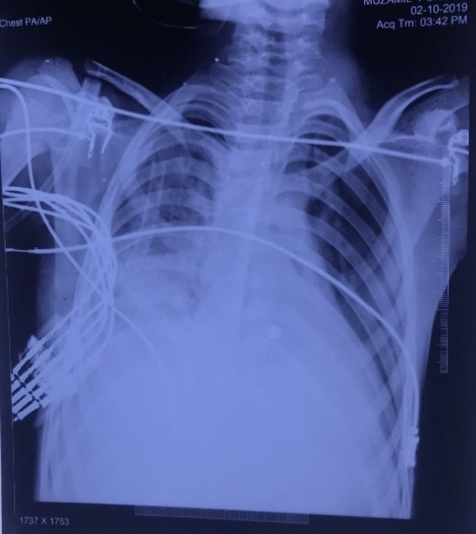 Surgical Outcome of Video-Assisted Thoracoscopic Surgery (VATS) in ...