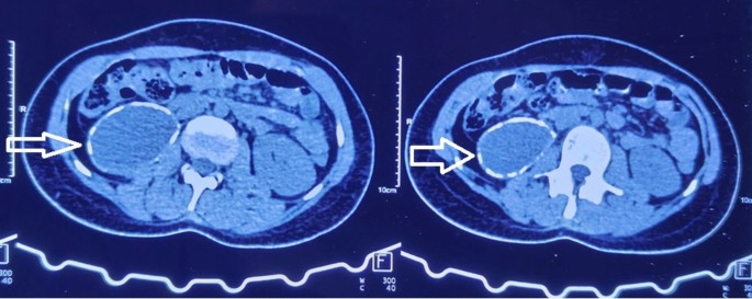 Cortical Nephrocalcinosis on X-Ray Whole Abdomen | Indian Journal of ...
