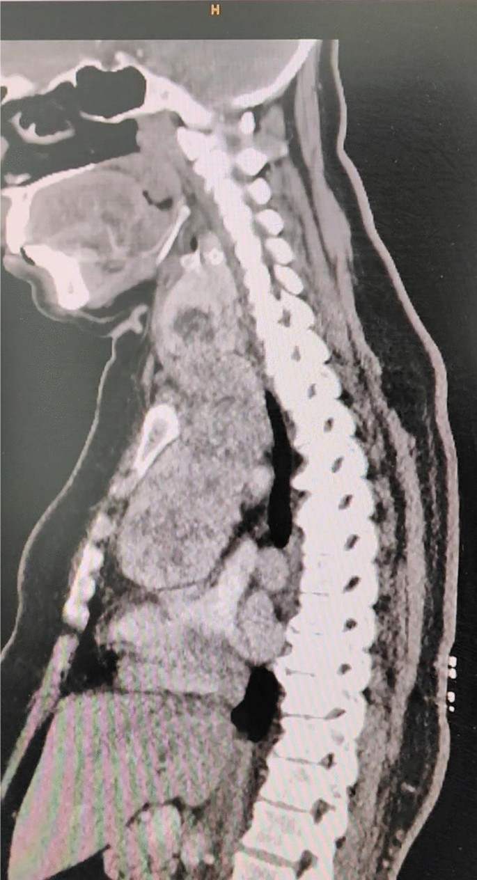 Rare Case of A Largest Intrathoracic Thyrothymic Thyroid Rest (TTR ...