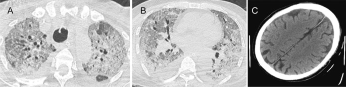 Aspergillus Brain Abscess Infection After Drowning in a Public Bath ...