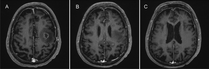 Aspergillus Brain Abscess Infection After Drowning in a Public Bath ...