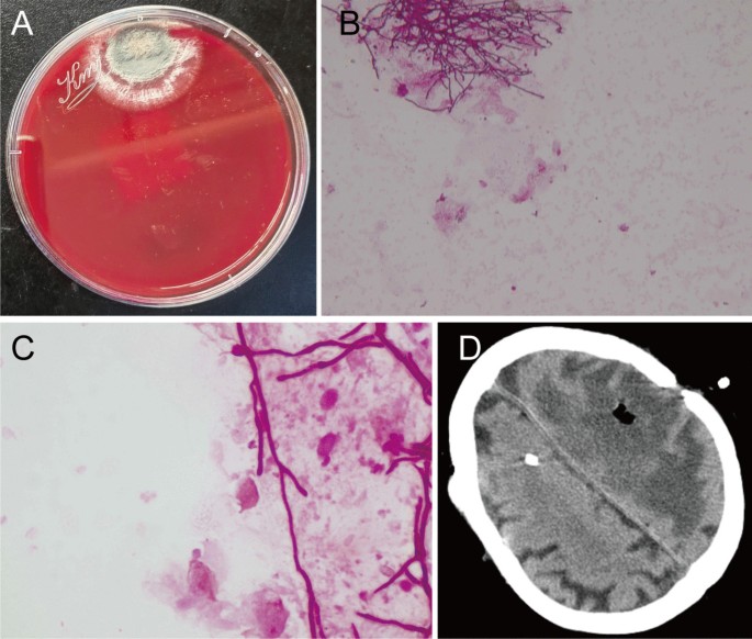 Aspergillus Brain Abscess Infection After Drowning in a Public Bath ...