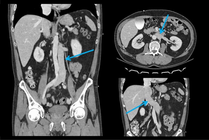 Persistent Left Inferior Vena Cava, A Very Rare Vascular Variant ...