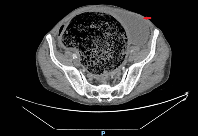 Giant Fecaloma Induced Bilateral Hydronephrosis: Renal Recovery ...
