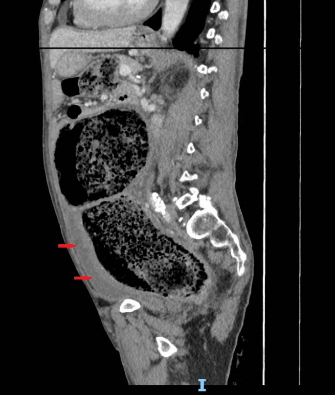 Giant Fecaloma Induced Bilateral Hydronephrosis: Renal Recovery ...