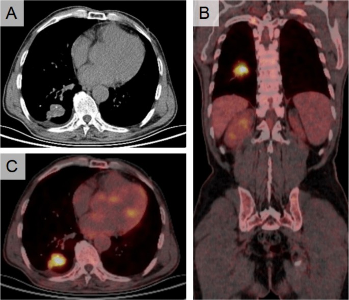 Predicting EGFR Mutation Status in Lung Adenocarcinoma using 18F-FDG ...