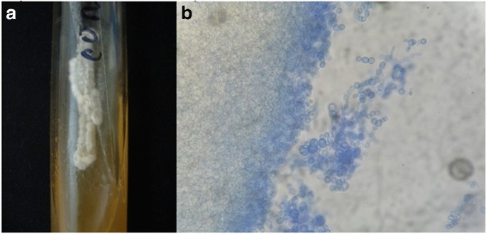 Primary Cutaneous Trichosporonosis | Current Fungal Infection Reports