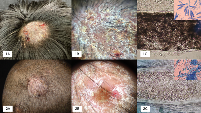 Update on the Treatment of Kerion Celsi | Current Fungal Infection Reports