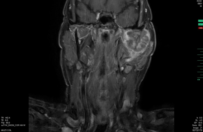 Raumforderung unklarer Genese im Unterkiefer | Die MKG-Chirurgie