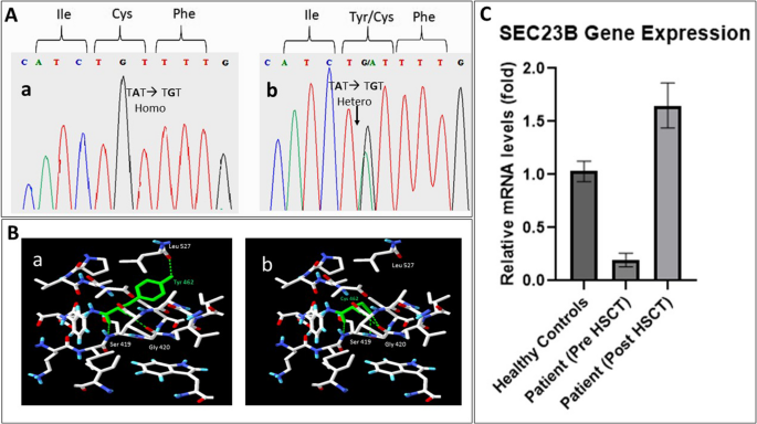Hematopoietic Stem Cell Transplant of a Congenital Dyserythropoietic ...