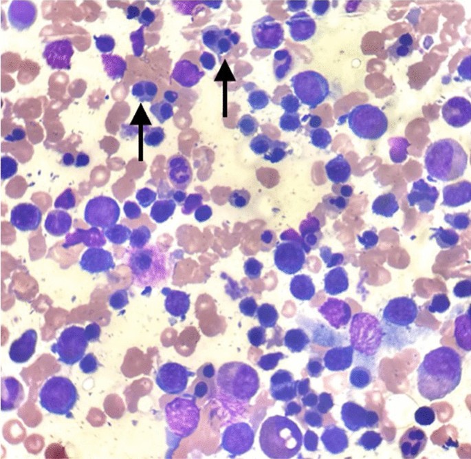 Congenital Dyserythropoietic Anaemia Type II with SEC23B Mutation in ...