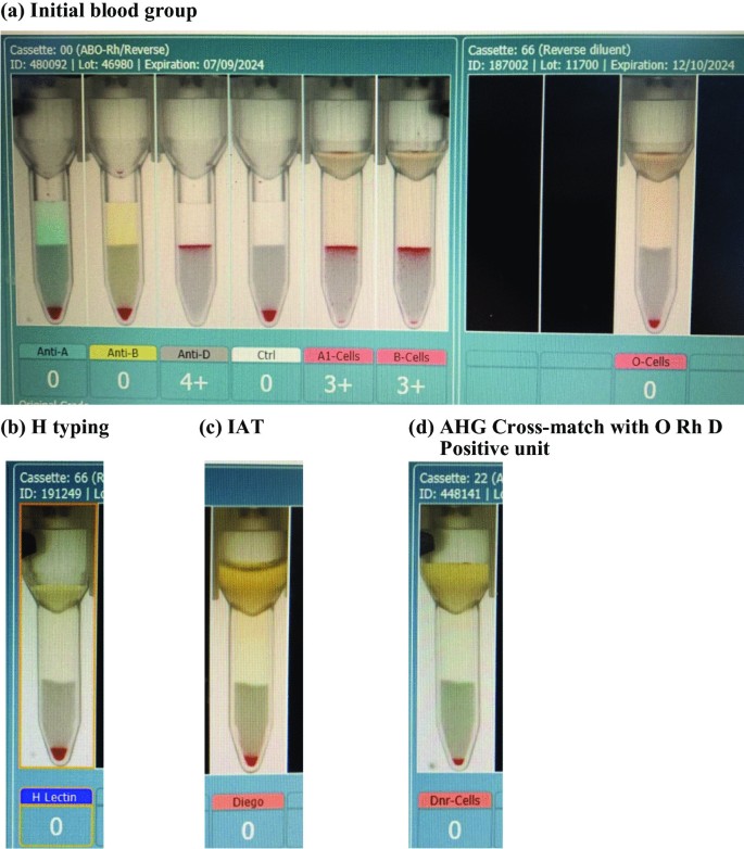 Bombay Group Phenotype or Group O Phenotype: A Serological Dilemma ...