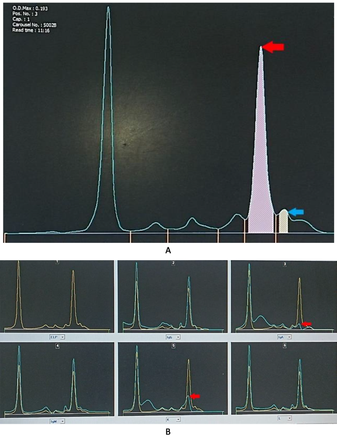Correlation of Flame Cells and Two Monoclonal Bands in Beta and Gamma ...