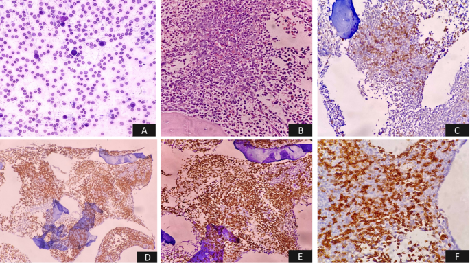 Novel Mutations in Acute Erythroid Leukemia–A Case Report with Review ...