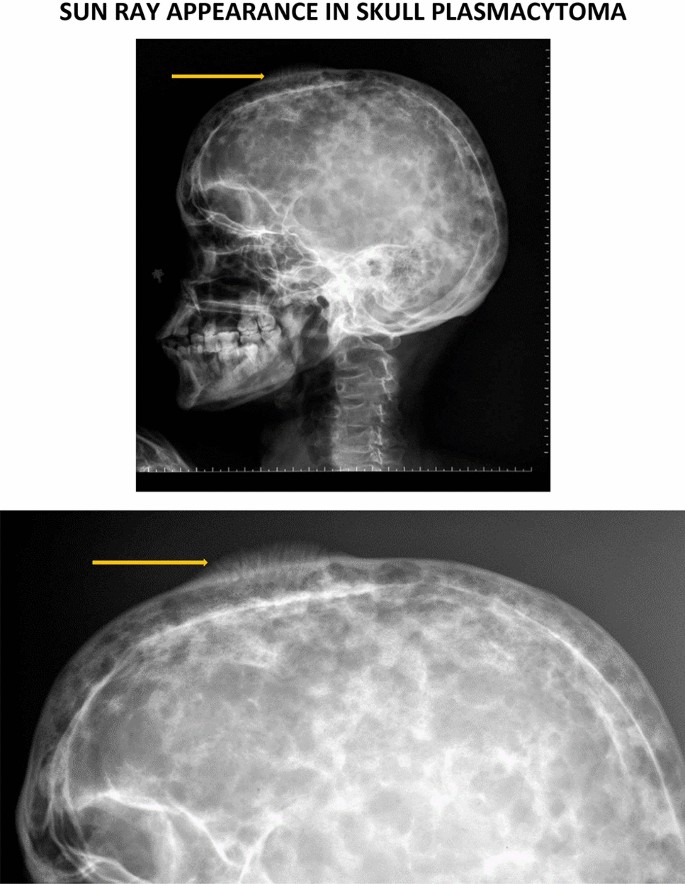 Sun Ray Appearance in Skull Plasmacytoma | Indian Journal of Hematology and Blood Transfusion