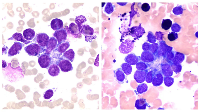 Rosettes in Acute Myeloid Leukemia: a Rare Misleading Cytology | Indian ...