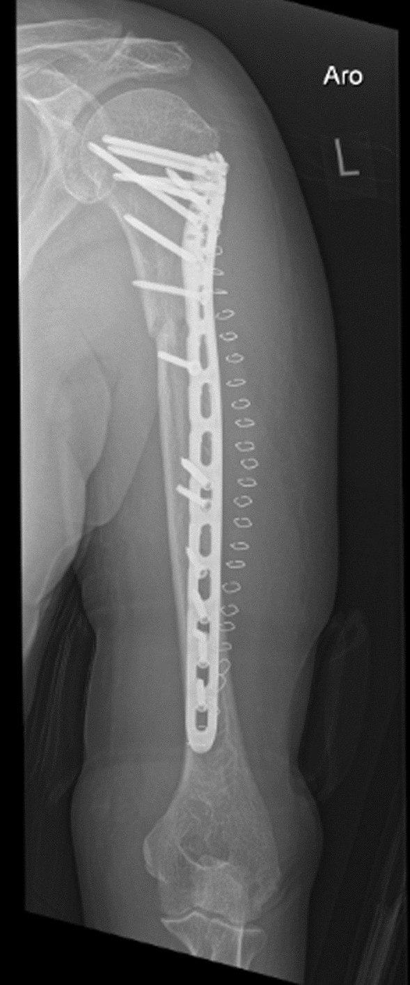 Ultrasound-guided localization of the radial nerve along the humerus ...