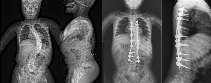 Surgical treatment of scoliosis in patients with osteogenesis ...