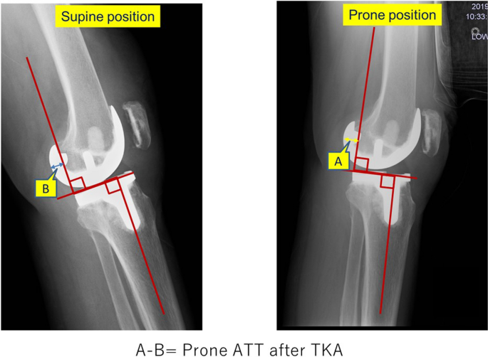 Radiographic evaluation of anterior tibial translation in the prone ...