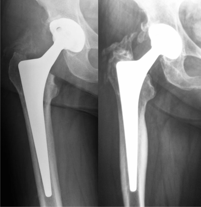 Comparative study of fitmore and CLS stems in total hip arthroplasty ...