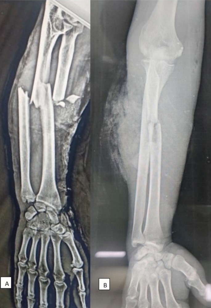 Role of titanium elastic nails in open forearm fractures in adults: a ...