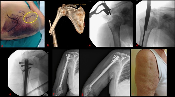 Comparison between anterolateral standard and percutaneous antero ...