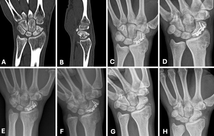 Revisiting the role of bone grafting in scaphoid fixation with volar ...
