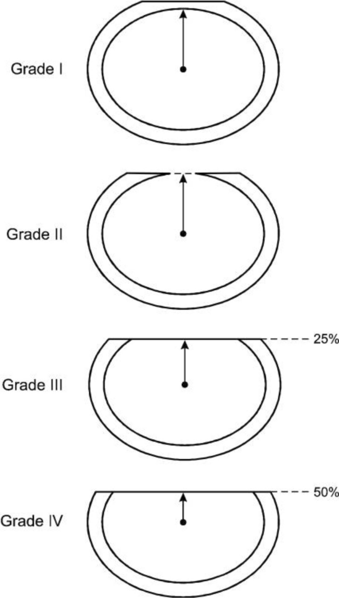 Anterior femoral notching during total knee arthroplasty: a predictor ...
