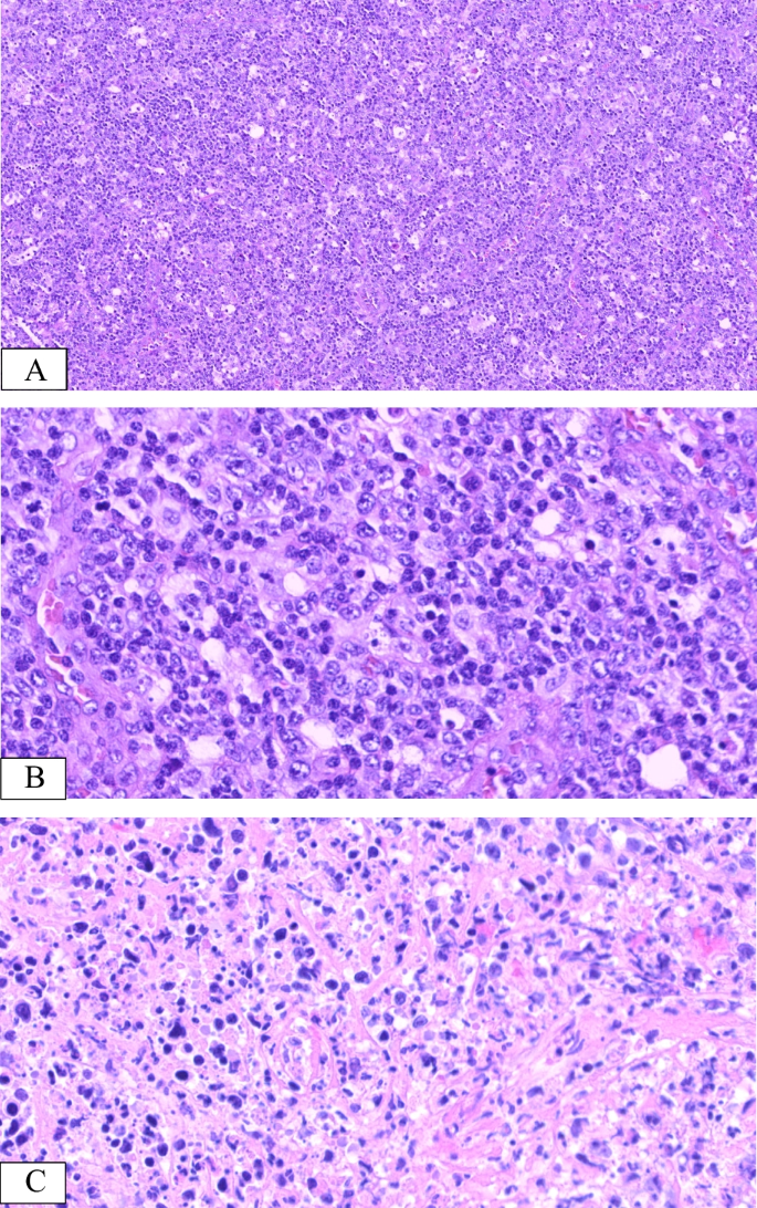Infectious mononucleosis complicated by transitory Epstein-Barr virus ...