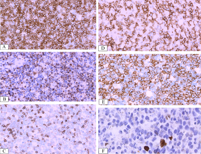 Infectious mononucleosis complicated by transitory Epstein-Barr virus ...