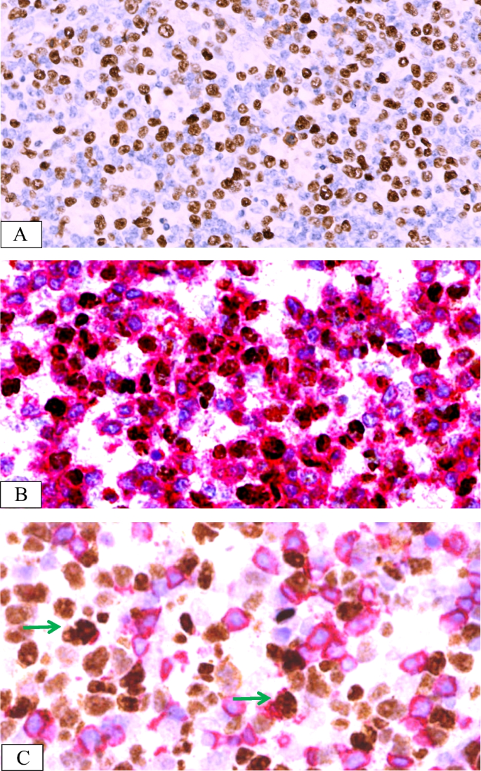 Infectious mononucleosis complicated by transitory Epstein-Barr virus ...