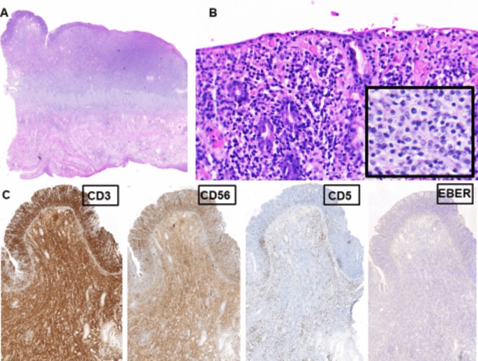 A case report and a literature review about central nervous system ...